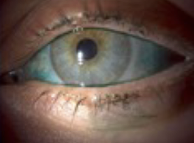 Efficacy of CEQUA® | Dry Eye Treatment